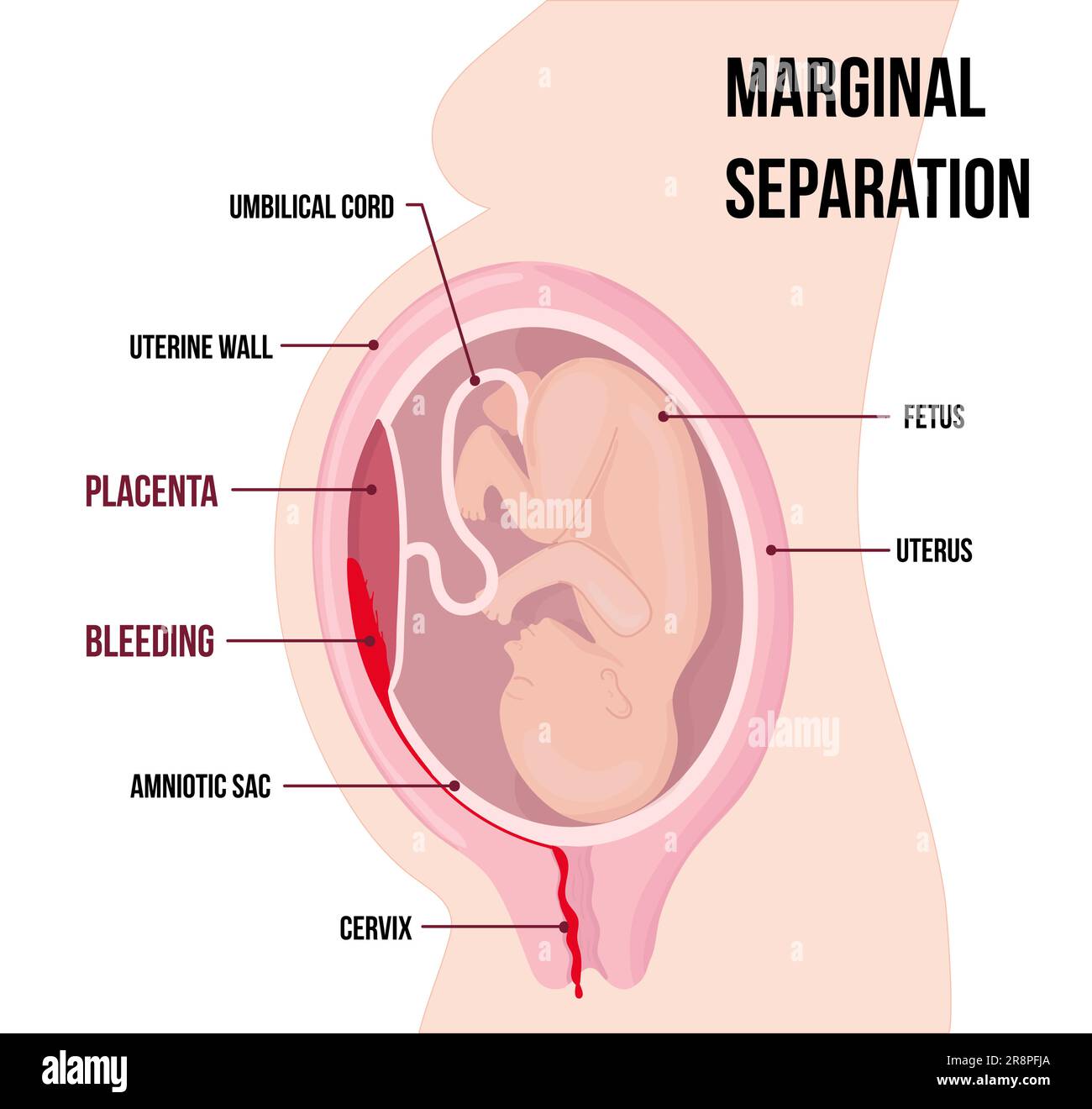 Tipos De Desprendimiento De Placenta