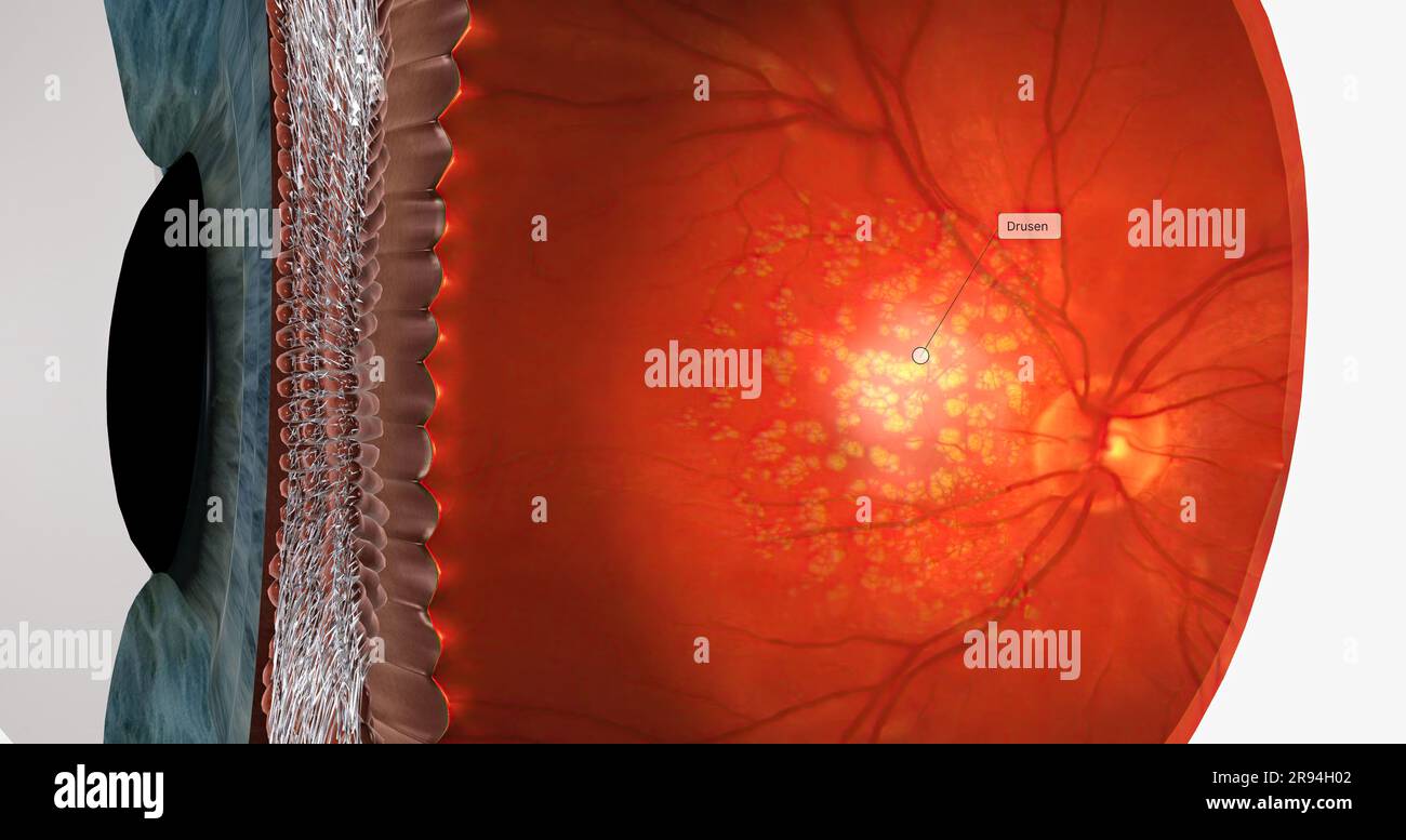 Degeneración Macular Seca : Degeneración Macular: Síntomas, Causas ...