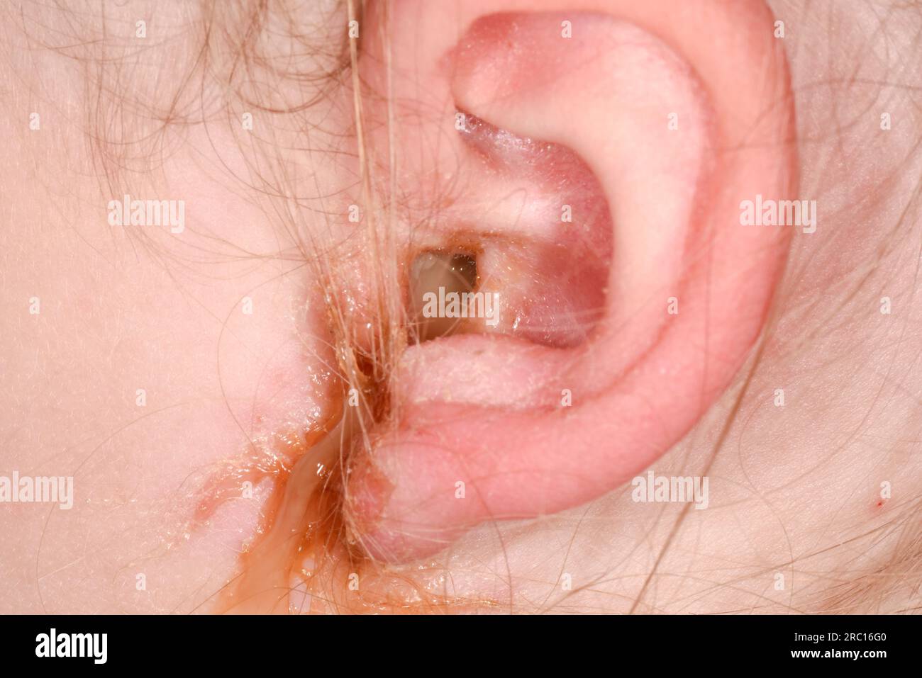 Infección Del Oído Fotografía De Stock Alamy