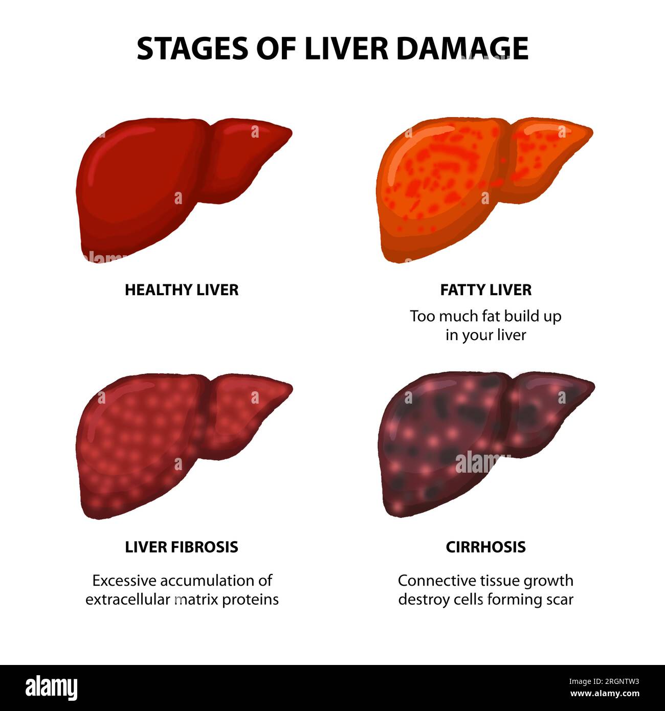 Cirrosis Del Higado Vs Higado Sano