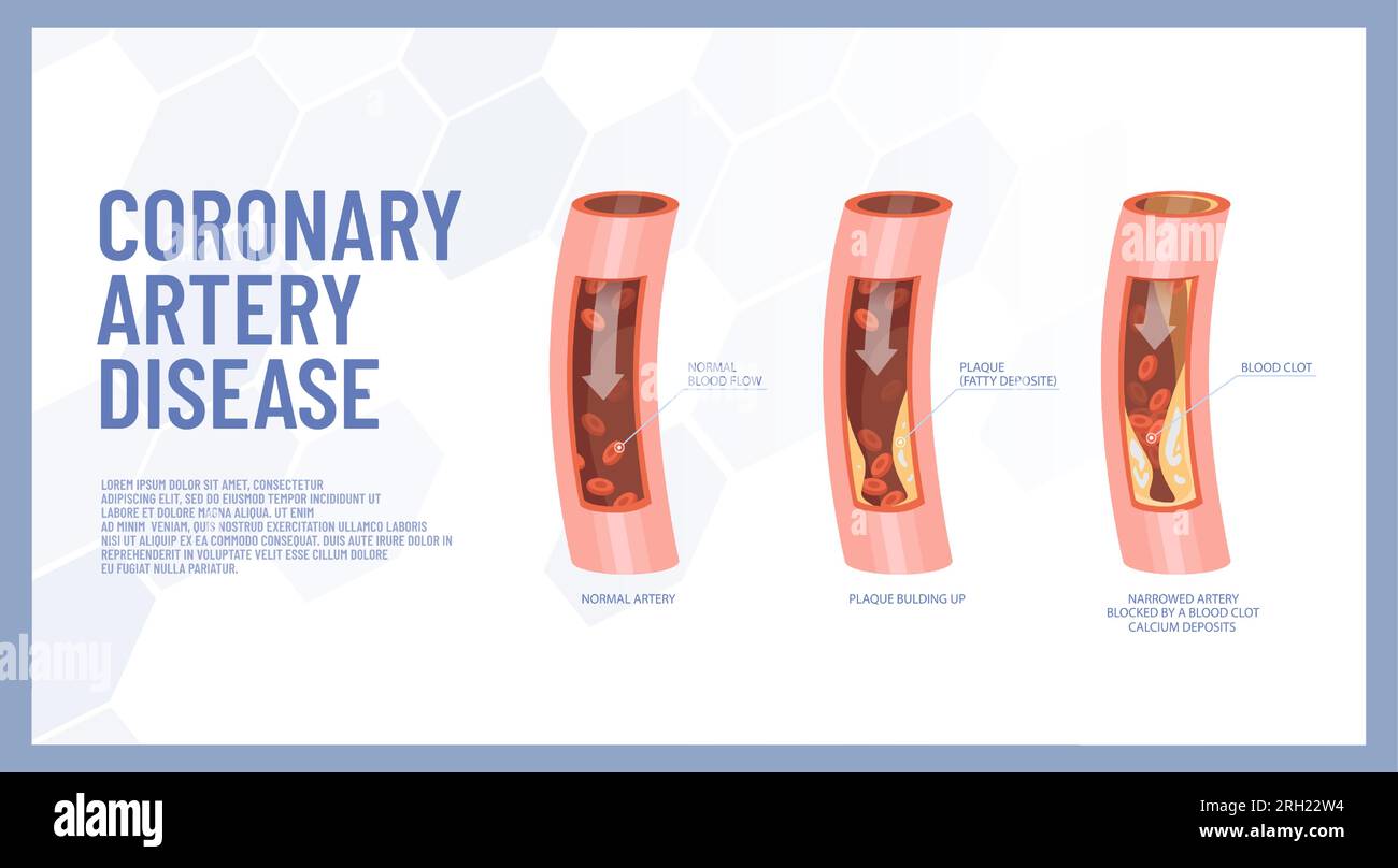 Enfermedad del corazón Imágenes vectoriales de stock - Alamy