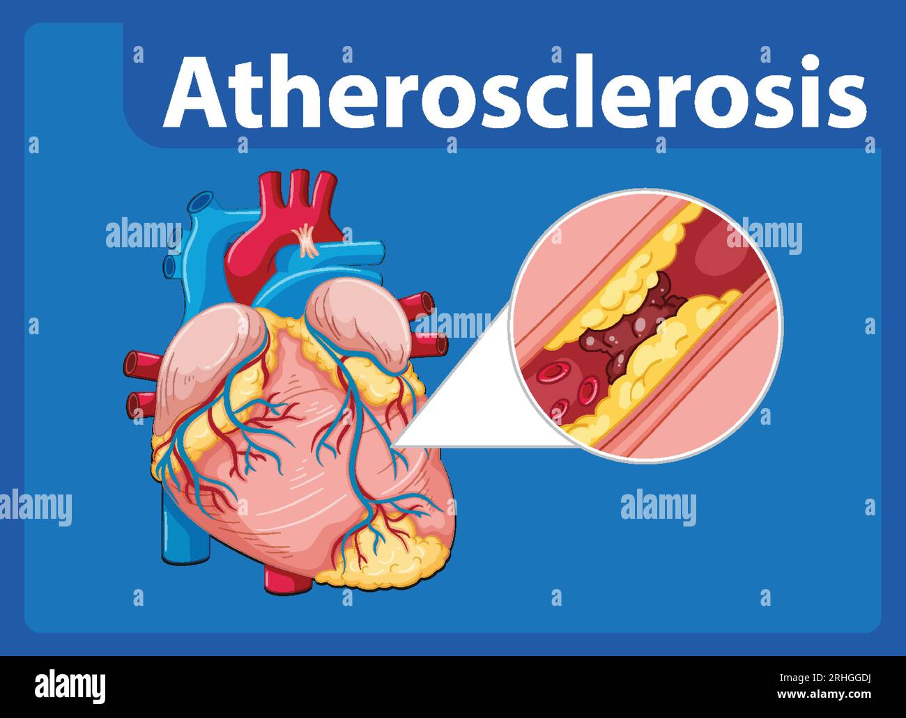 Aterosclerosis Corazón