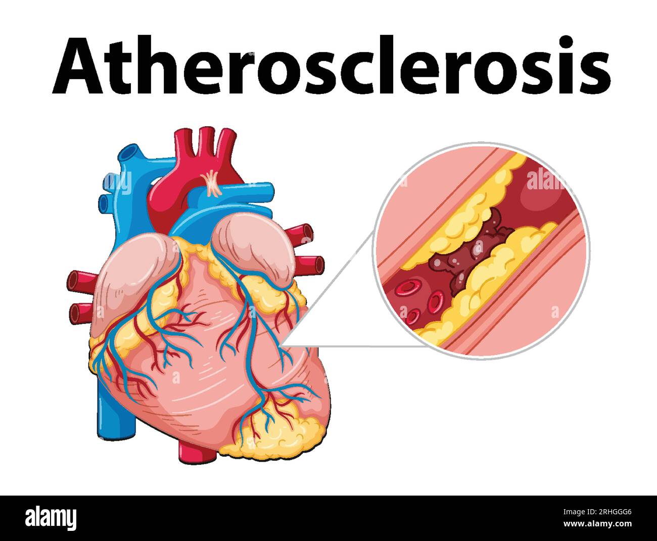 Aterosclerosis Corazón