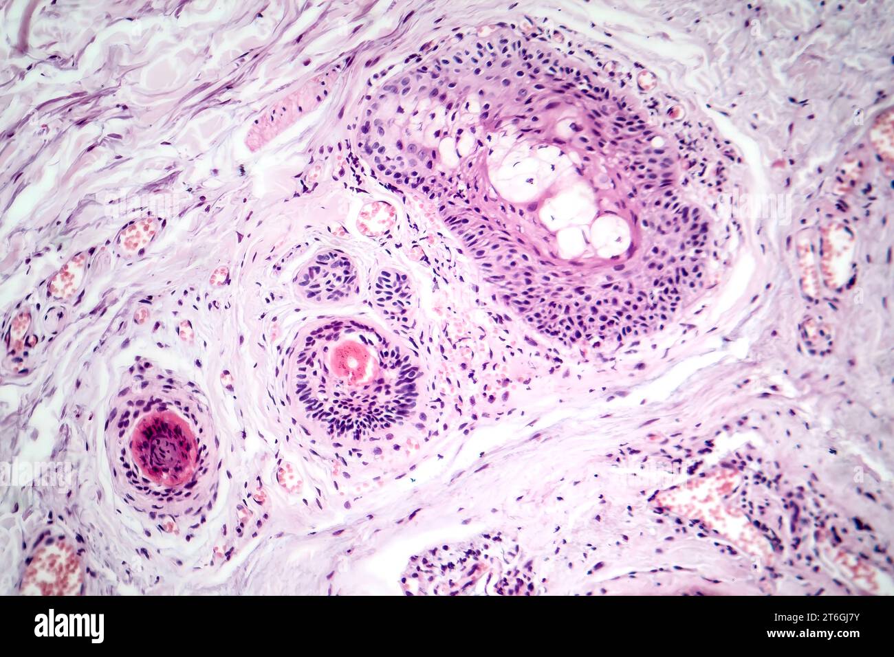 Fotomicrografía Del Carcinoma Basocelular Que Muestra Células Basales