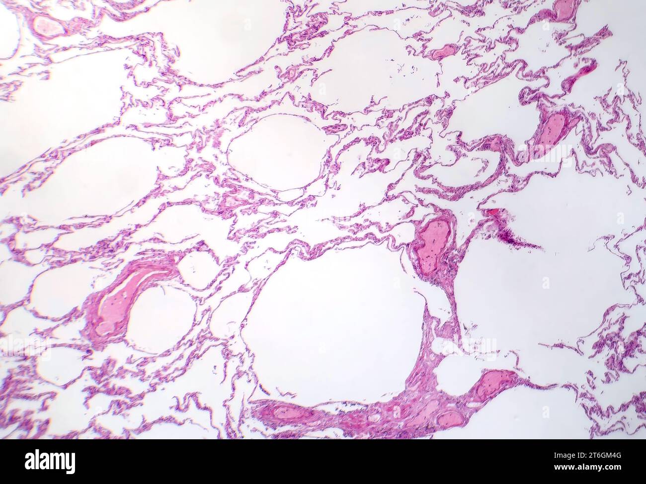 Lámina De Enfisema Pulmonar
