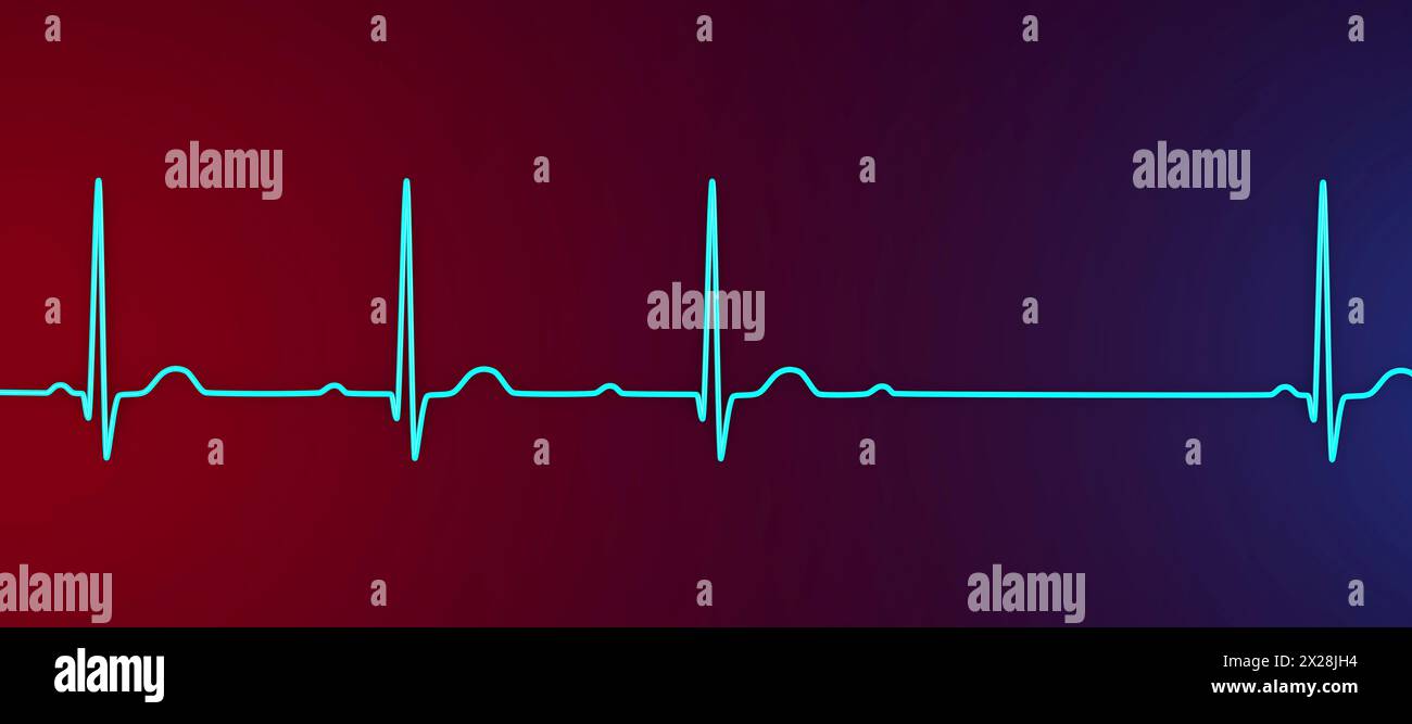Ecg Anormal Etiquetado