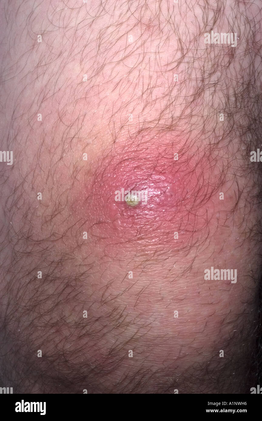 Estafilococo Epidermidis Piel