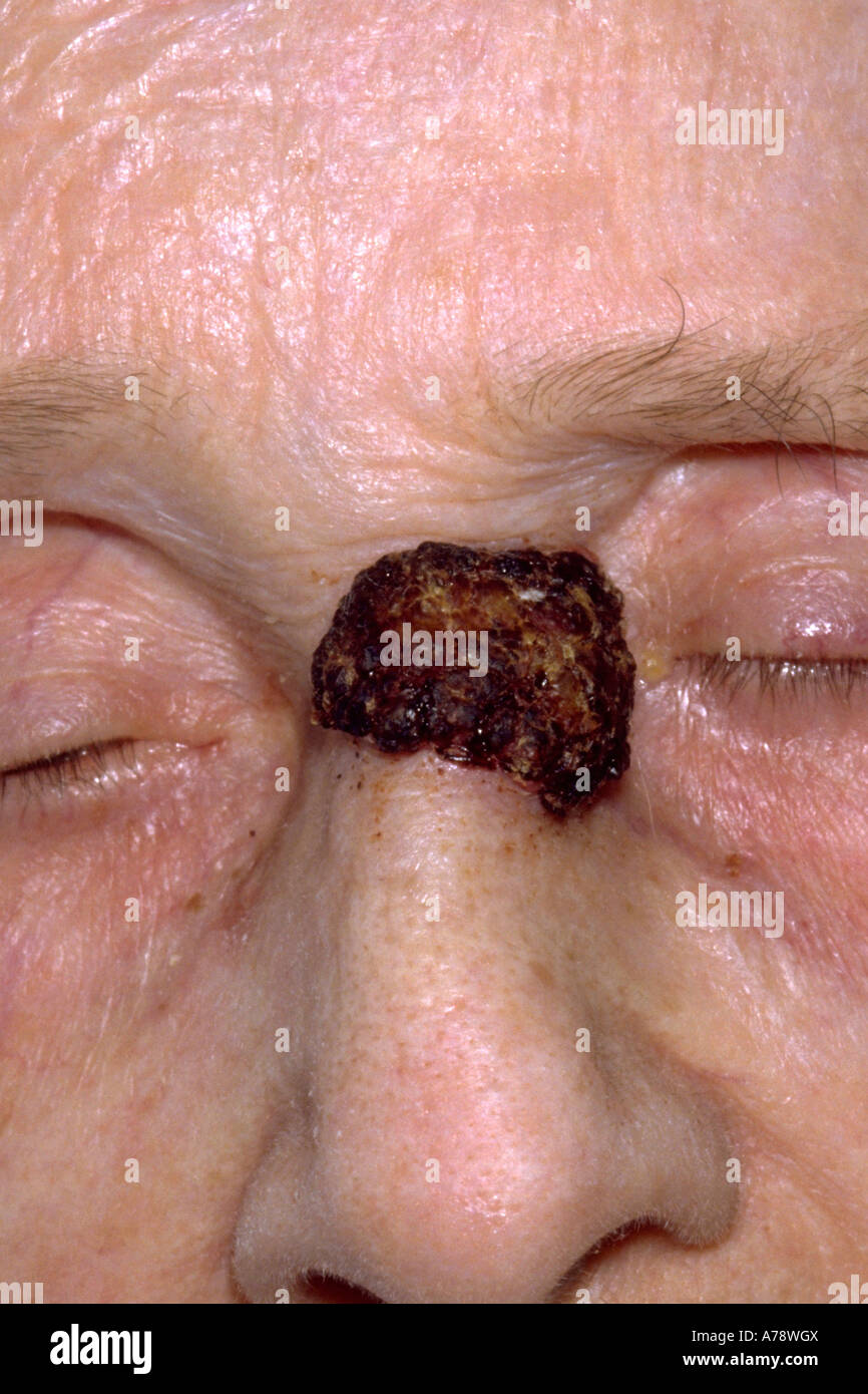Carcinoma De CÉlulas Escamosas Fotografía De Stock Alamy
