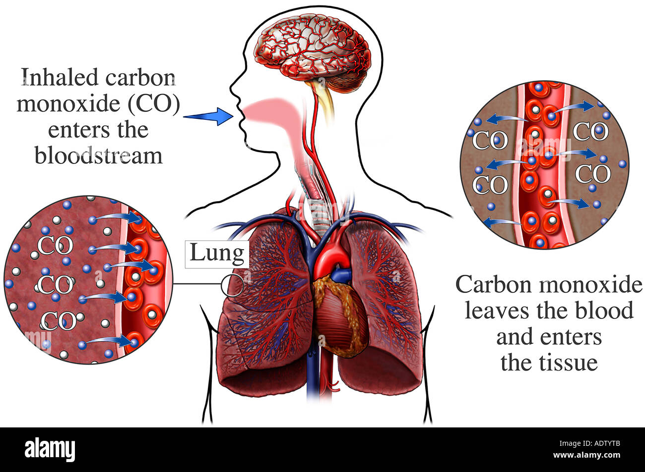 Intoxicaçao Por Monoxido De Carbono - FDPLEARN