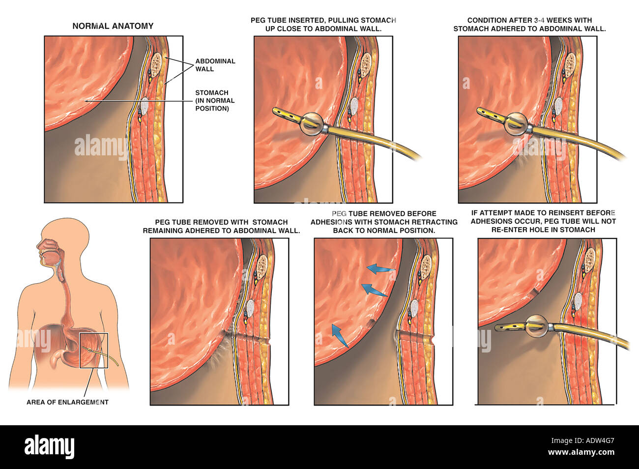 La gastrostomía endoscópica percutánea (PEG) de tubo Fotografía de ... La gastrostomía endoscópica percutánea (PEG) de tubo Fotografía de ...