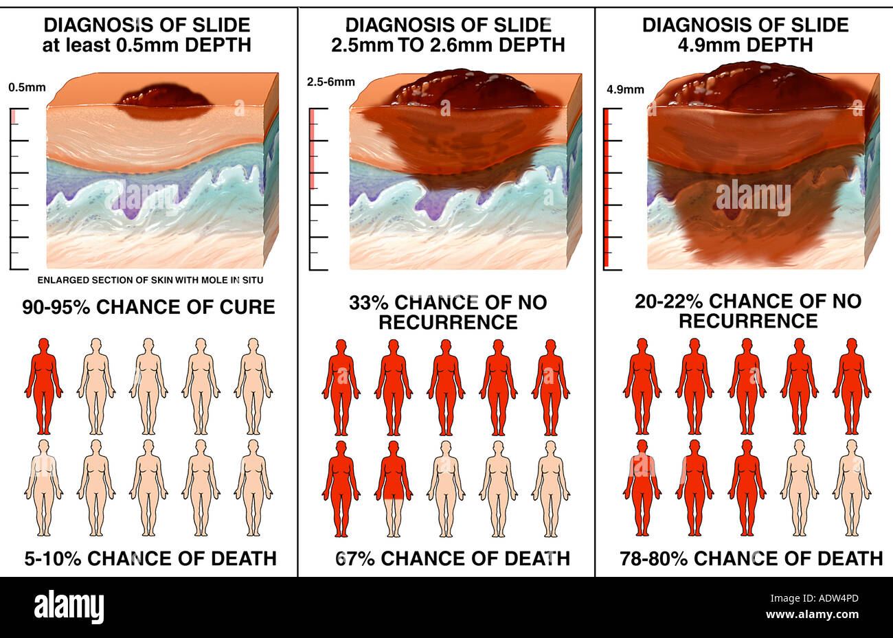 Melanoma Maligno Fotografías E Imágenes De Alta Resolución Alamy