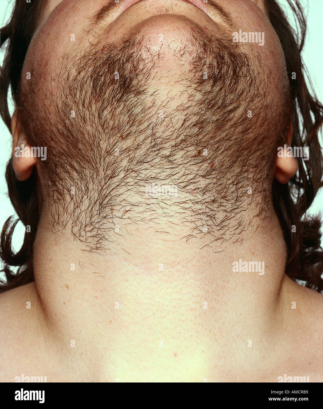 Stein Leventhal Syndrome Fotografías E Imágenes De Alta Resolución Alamy
