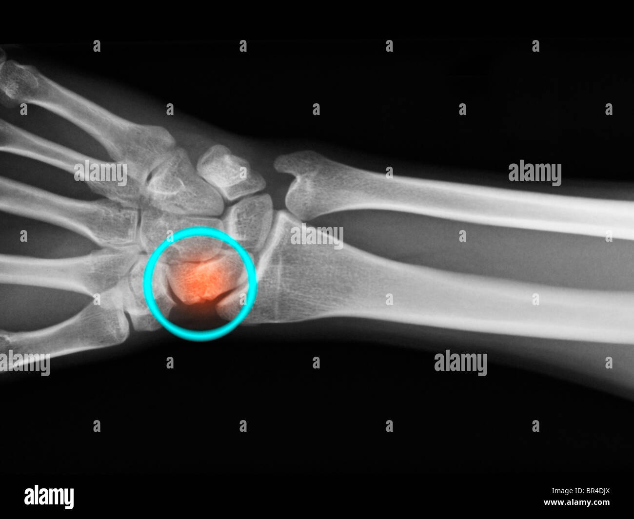Radiografía de la mano mostrando una fractura del hueso escafoides o ... Radiografía de la mano mostrando una fractura del hueso escafoides o ...