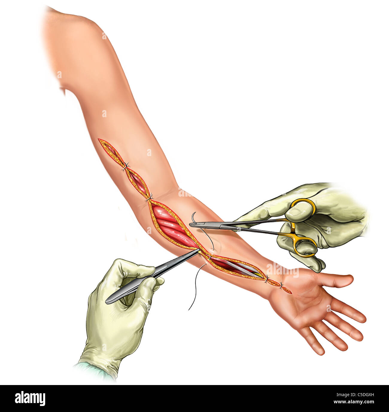 Fasciotomía Del Antebrazo Fotografías E Imágenes De Alta Resolución Alamy