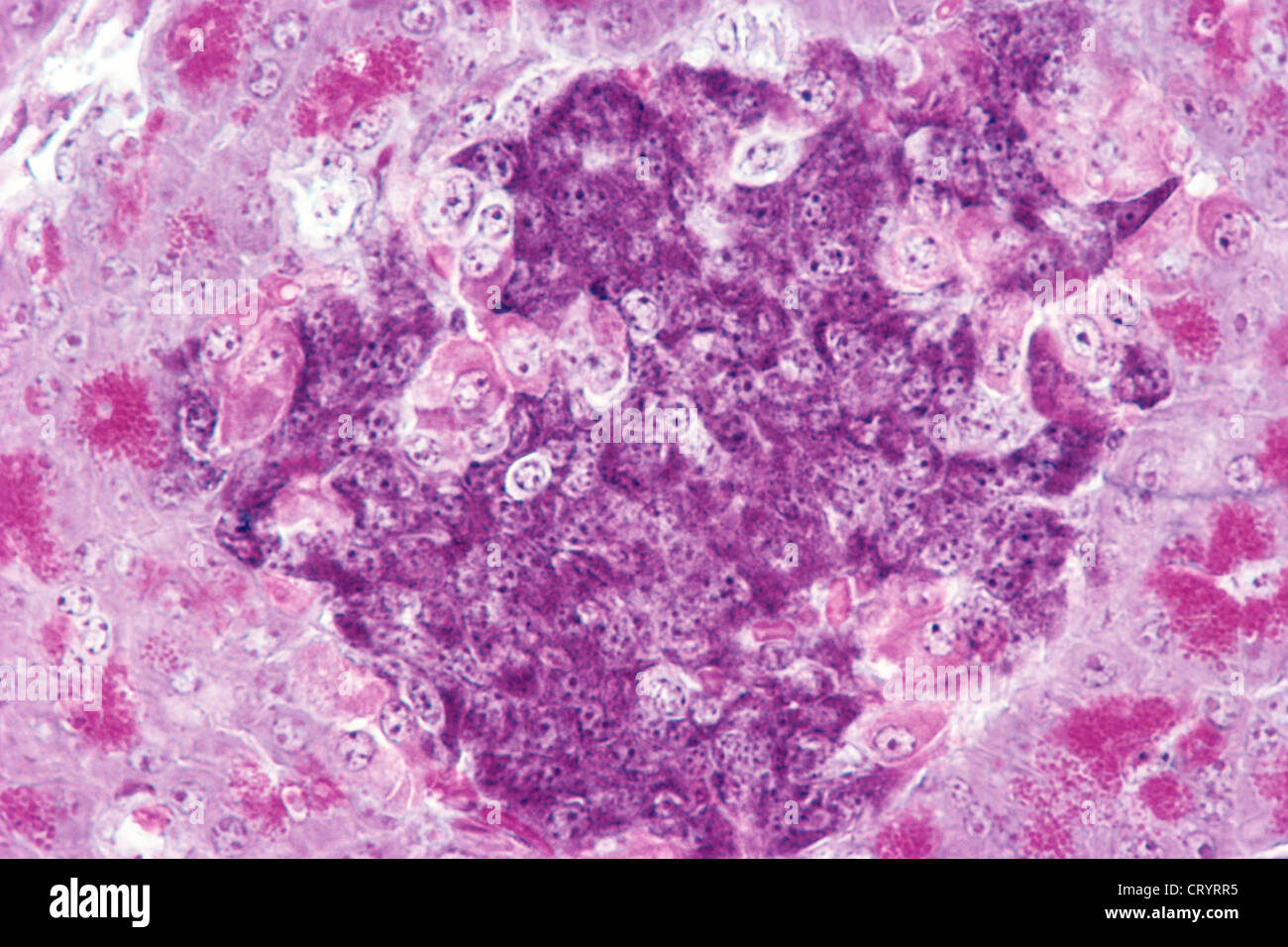 Diabetes Tipo 1 Páncreas Histología