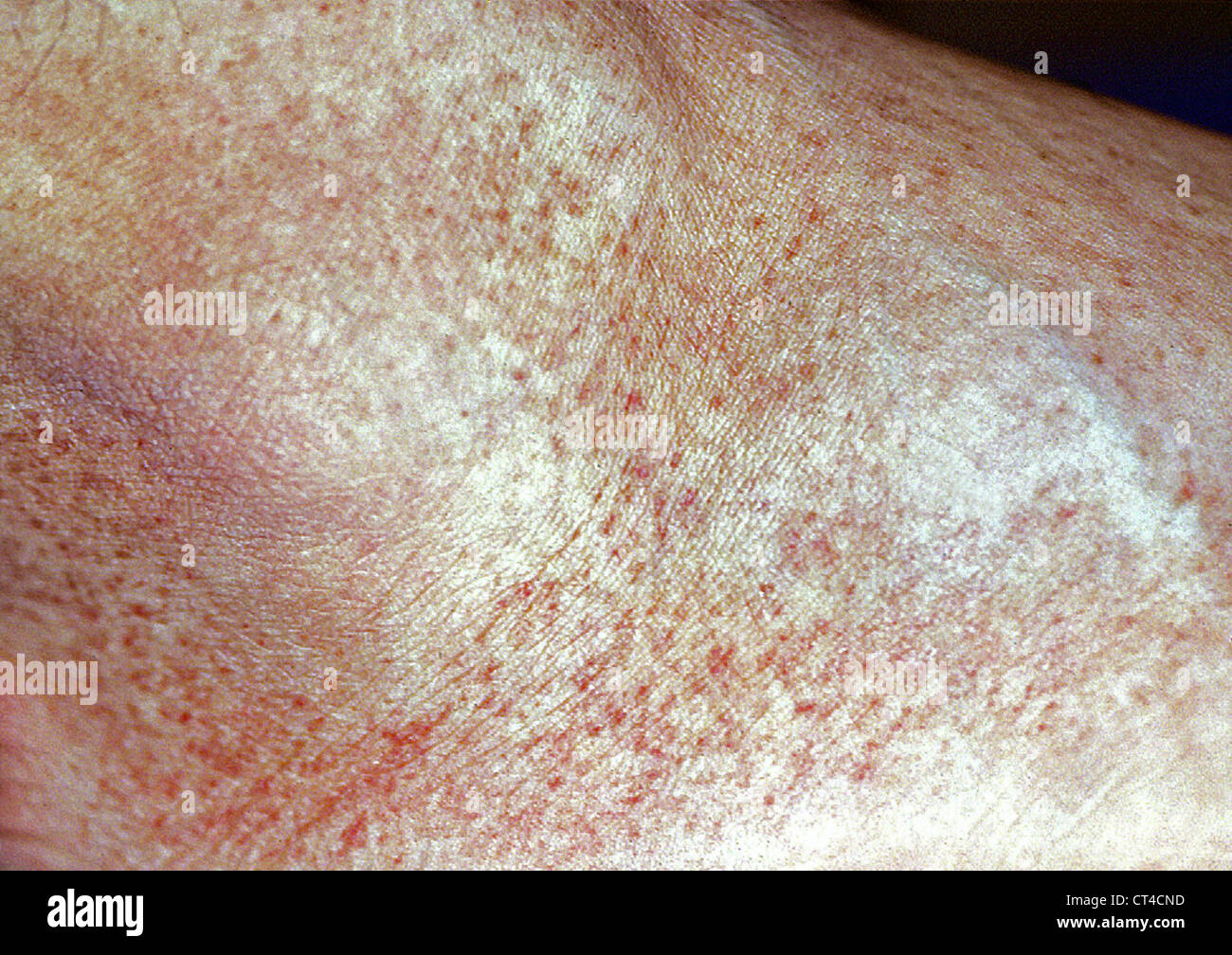 Purpura Skin Fotos e Imágenes de stock - Alamy