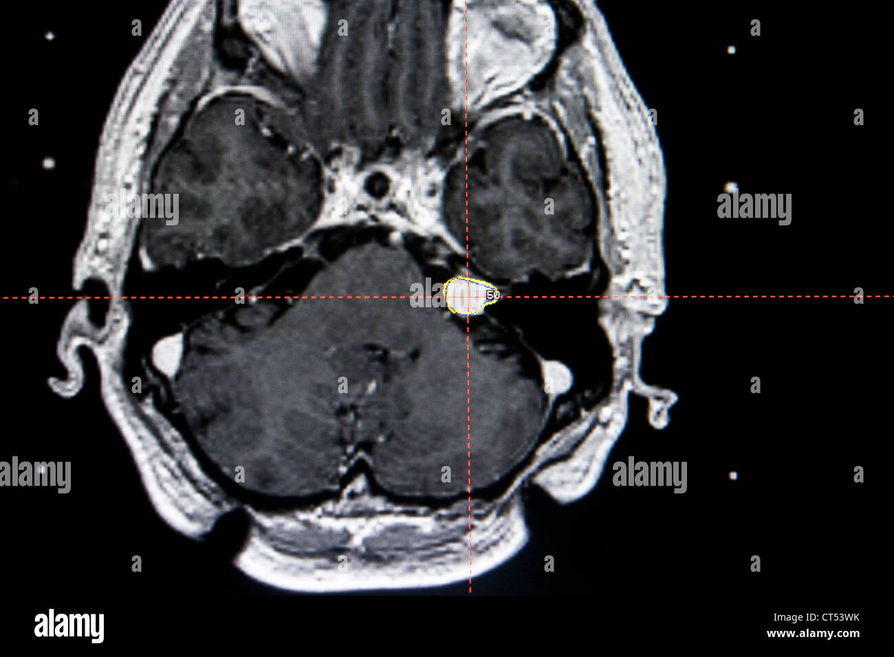 Nervio Vestibular Fotografías E Imágenes De Alta Resolución Alamy
