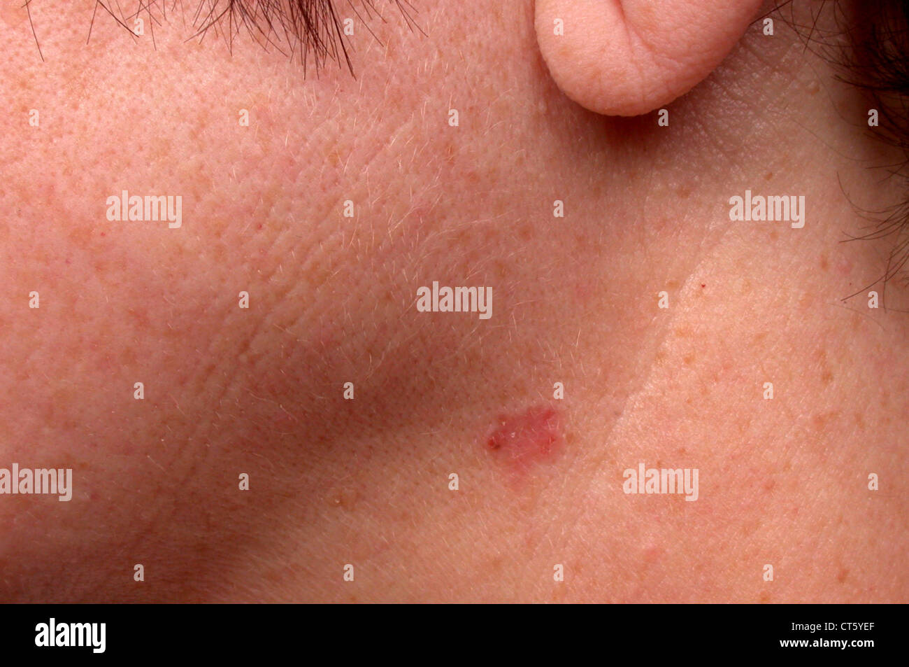 CARCINOMA de células basales Fotografía de stock - Alamy CARCINOMA de células basales Fotografía de stock - Alamy