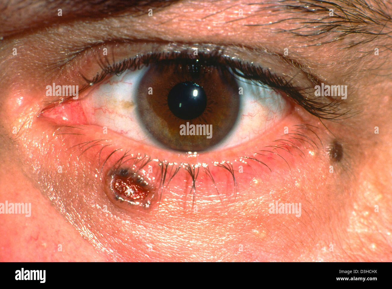 CARCINOMA de células basales Fotografía de stock - Alamy CARCINOMA de células basales Fotografía de stock - Alamy