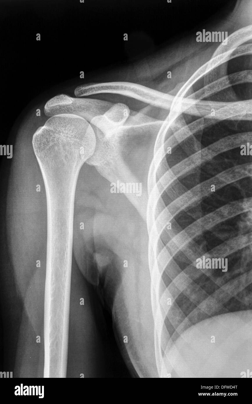 Hombro Normal De Rayos X