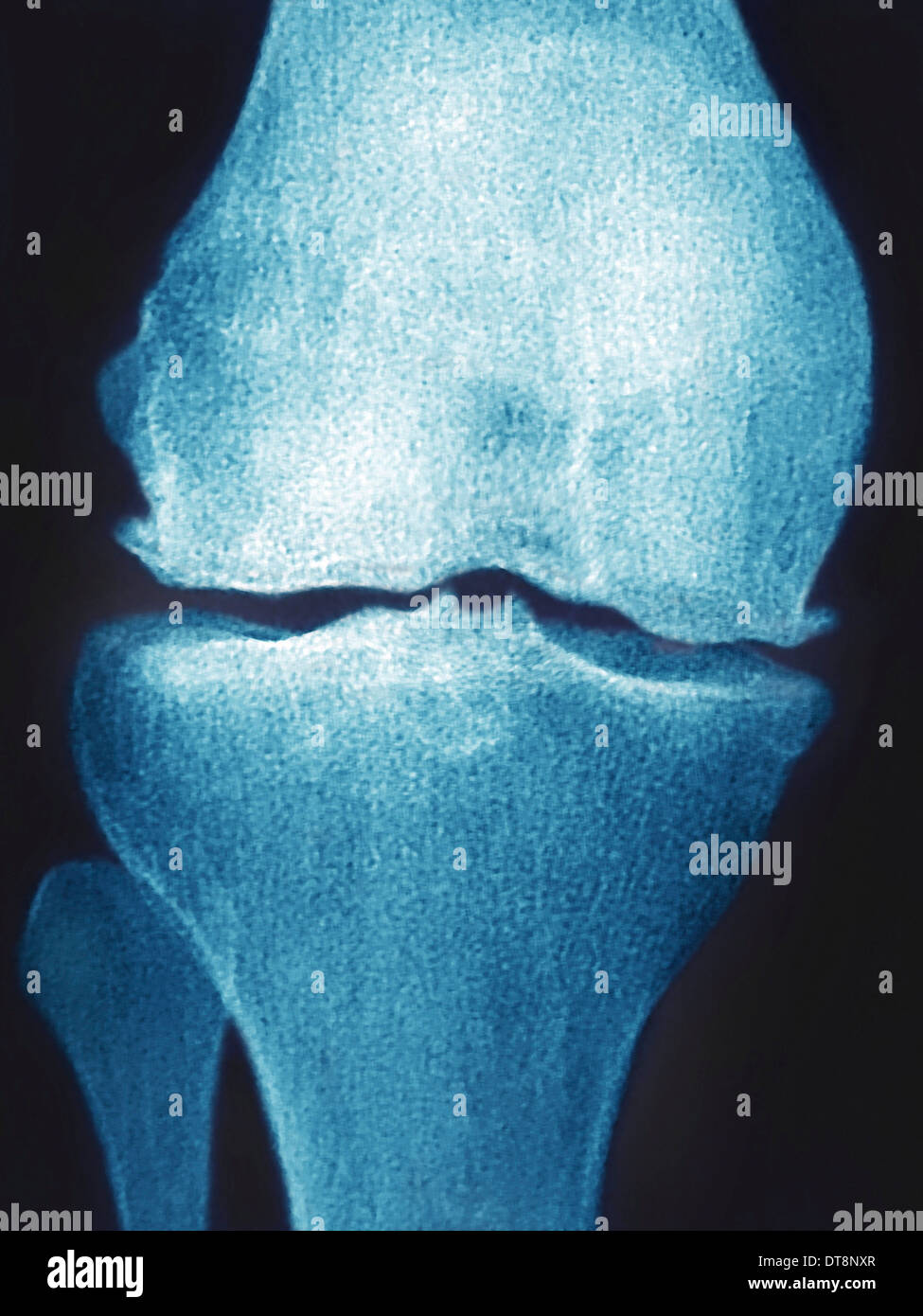 Osteoartritis de la rodilla, rayos X Fotografía de stock - Alamy Osteoartritis de la rodilla, rayos X Fotografía de stock - Alamy