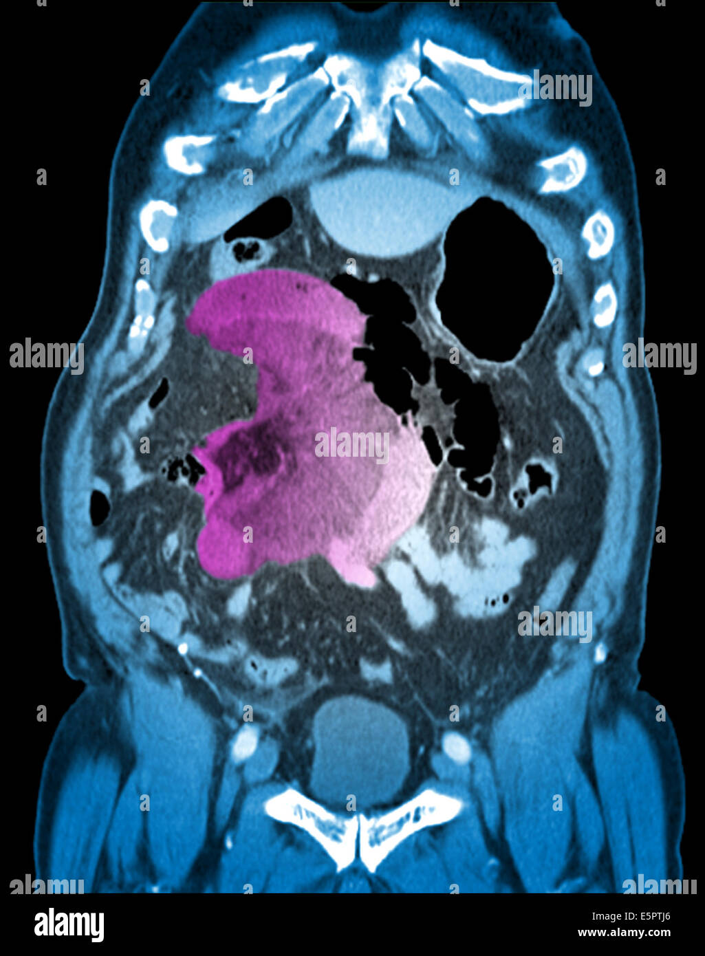 Escribe un reporte Nota métrico en un tac abdominal se ve el colon ...