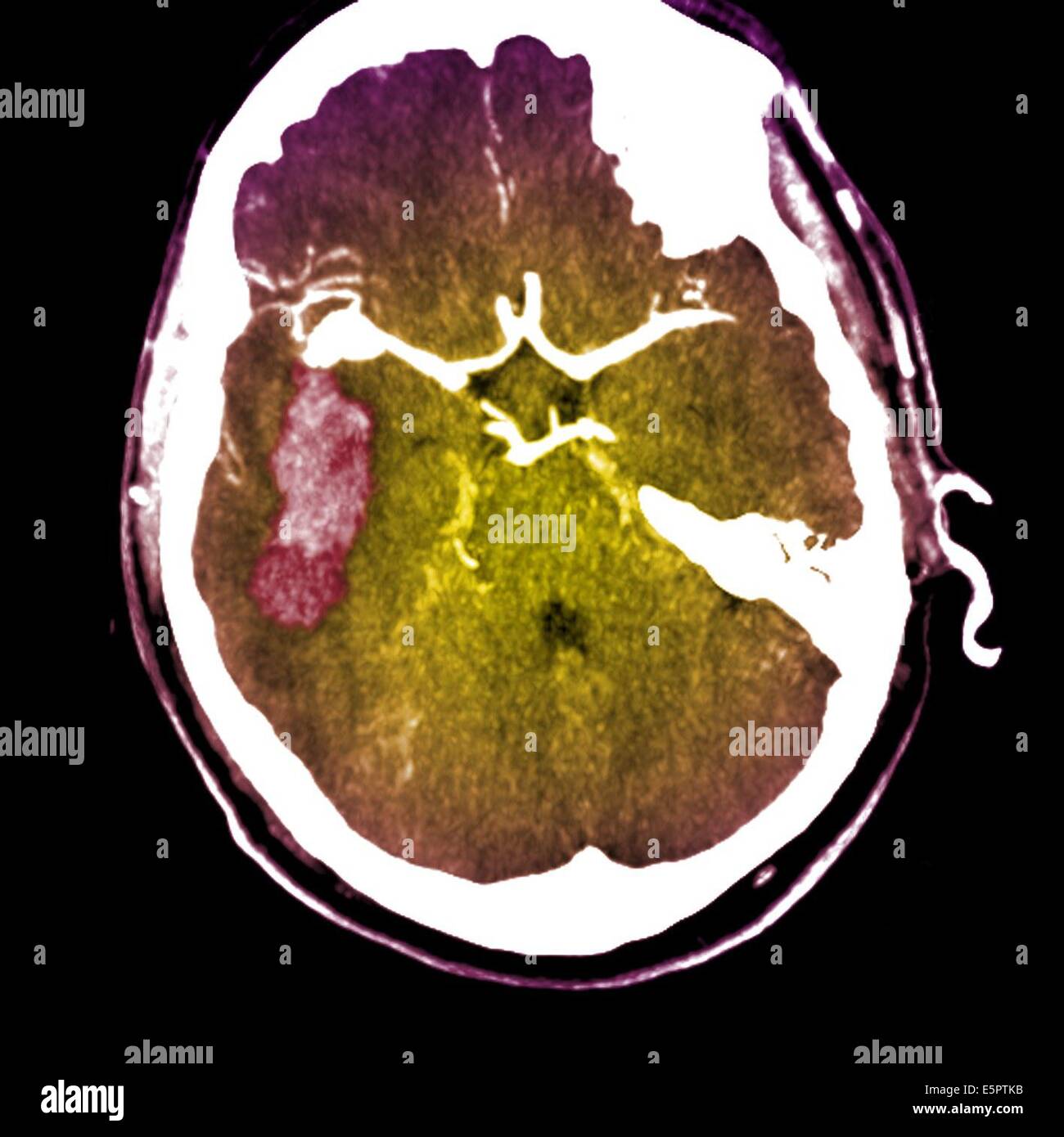 Tomografía Axial Computarizada Tac Del Cerebro Mostrando Una Ruptura
