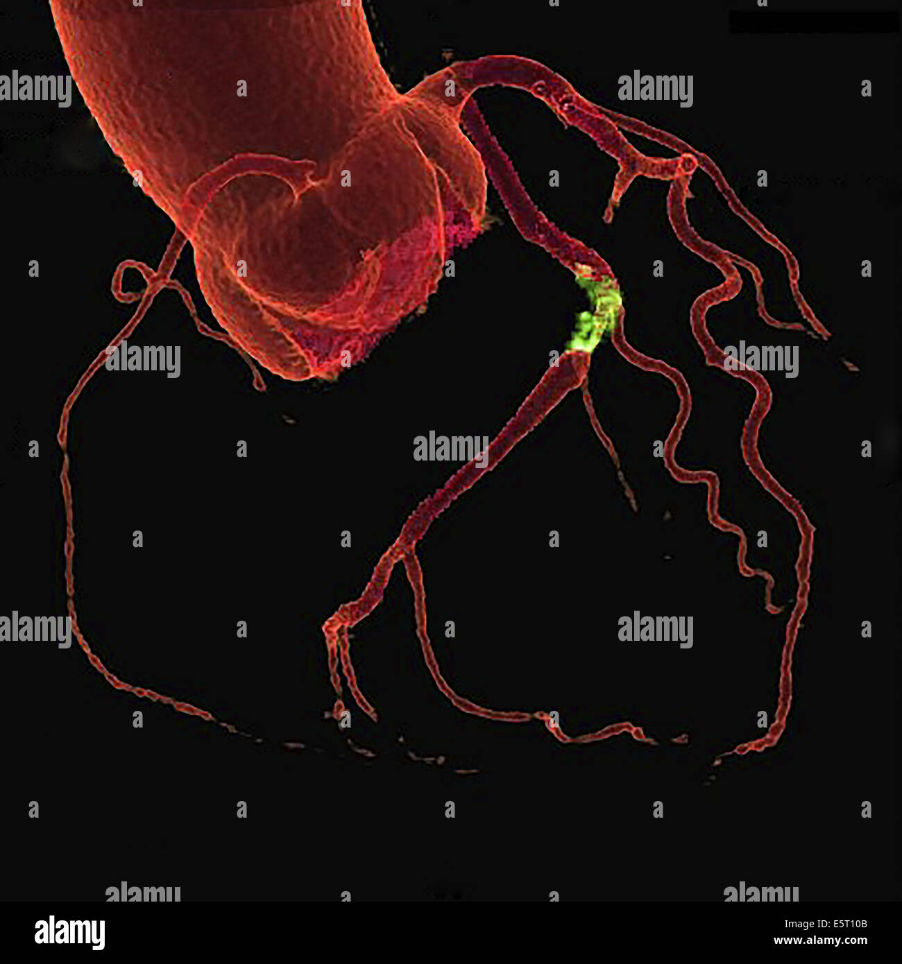 3-D de color tomografía axial computarizada (TAC) del corazón que ...