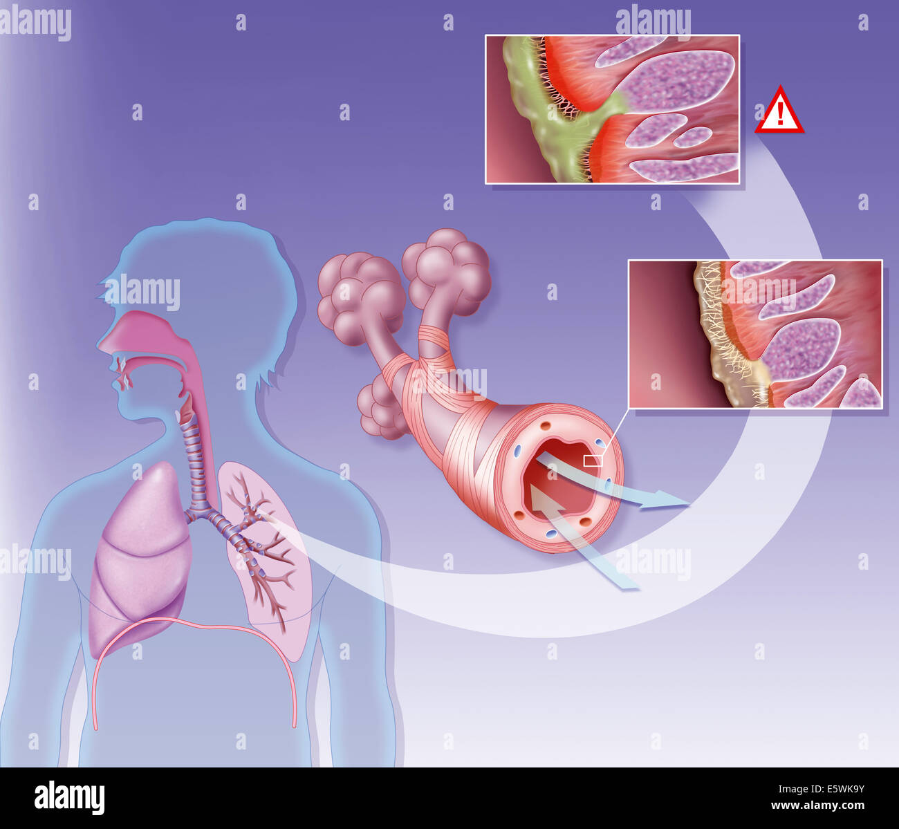 Bronquitis Aguda Pulmones