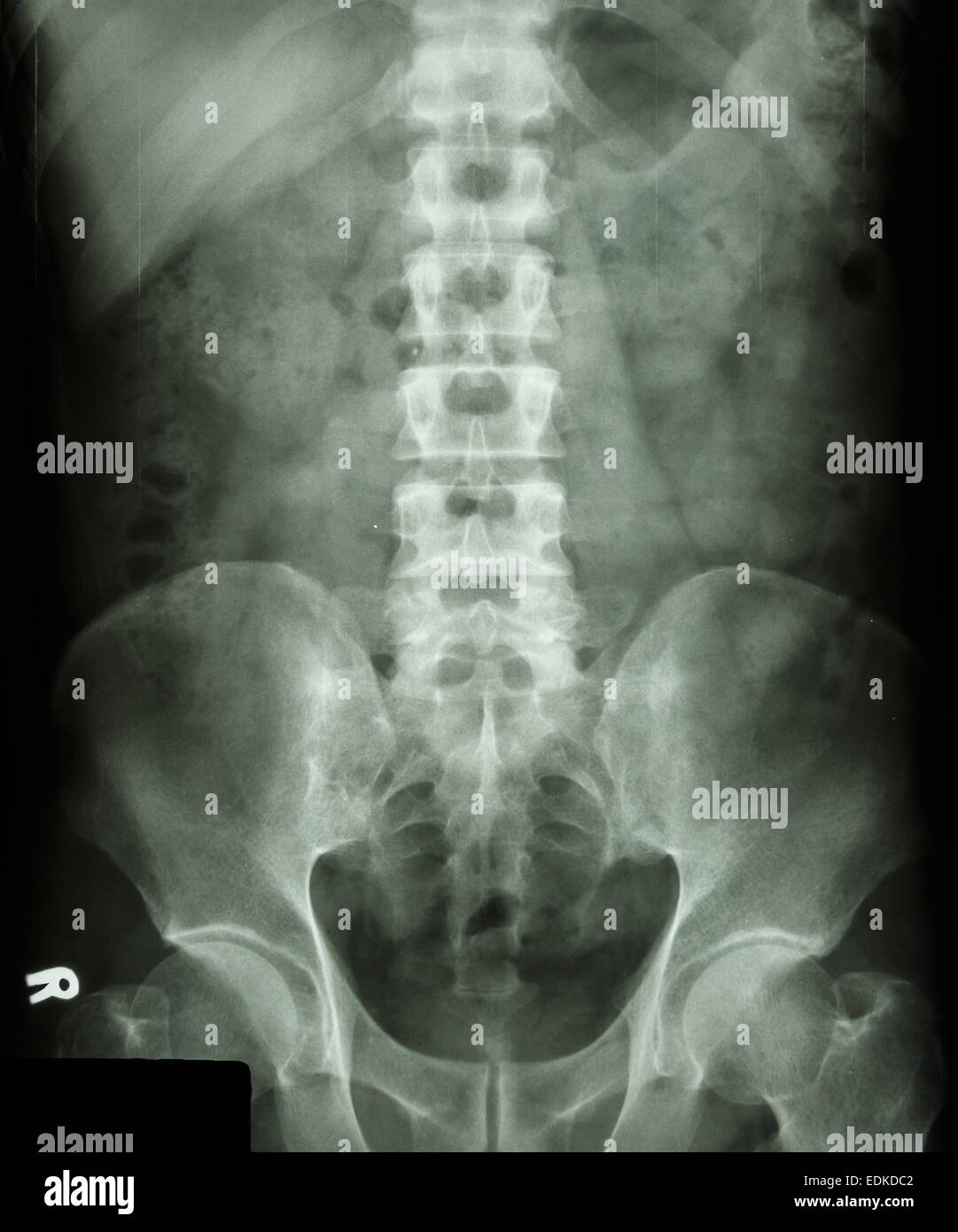Ap Lumbar Spine X Ray Sexiz Pix