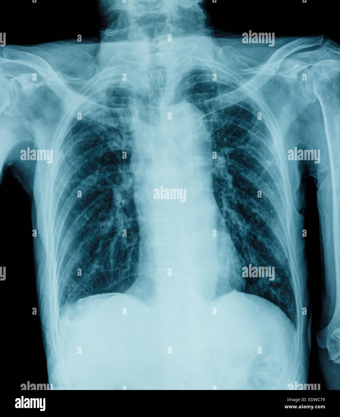 Radiografía De Pulmón Normal Fotografías E Imágenes De Alta Resolución