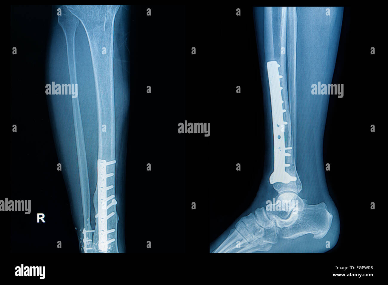 Fractura De Tobillo Y Tibia Broken Fibula X Ray