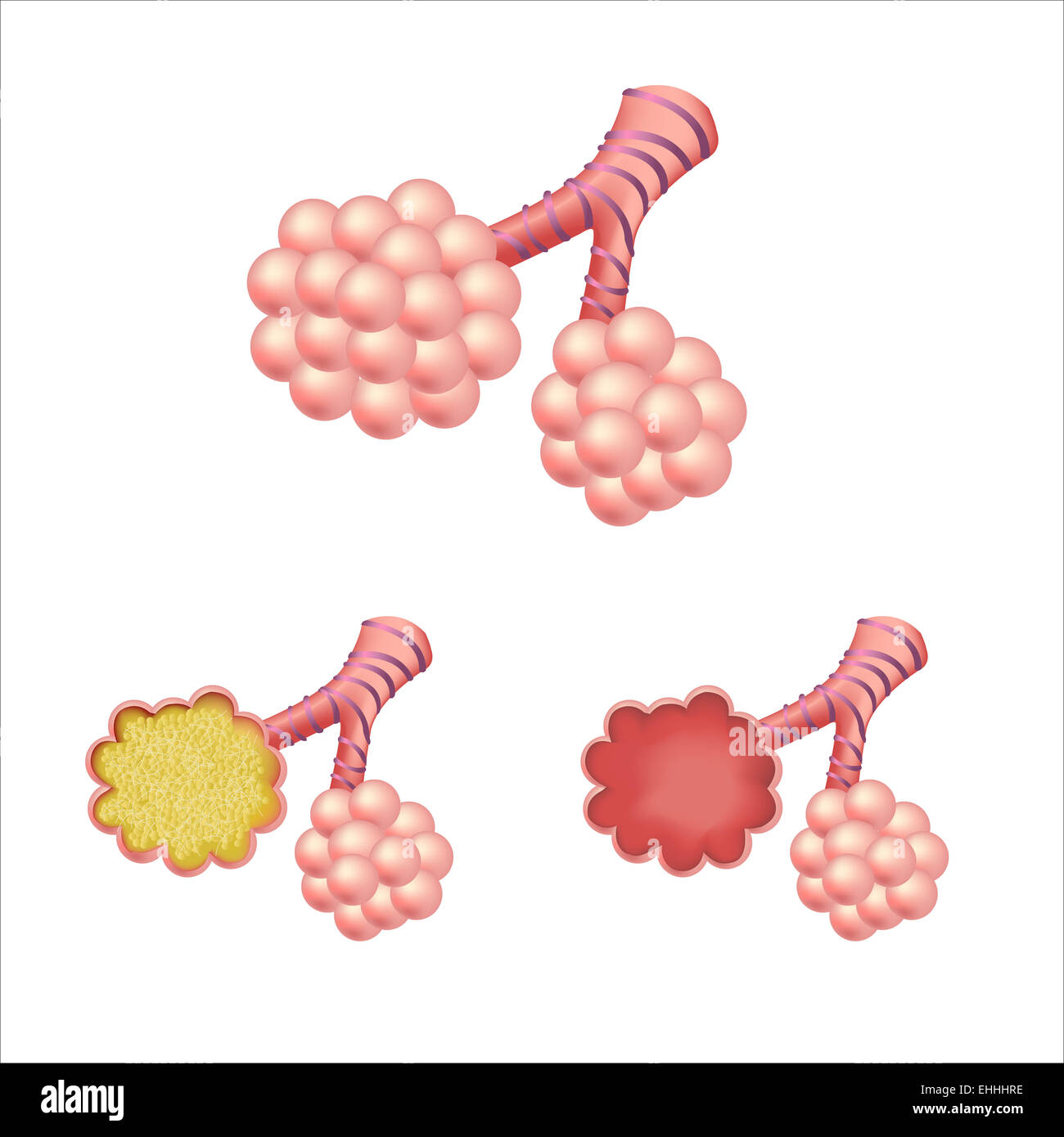 Alvéolos En Enfermedades Pulmonares Ilustración Del, 54% OFF