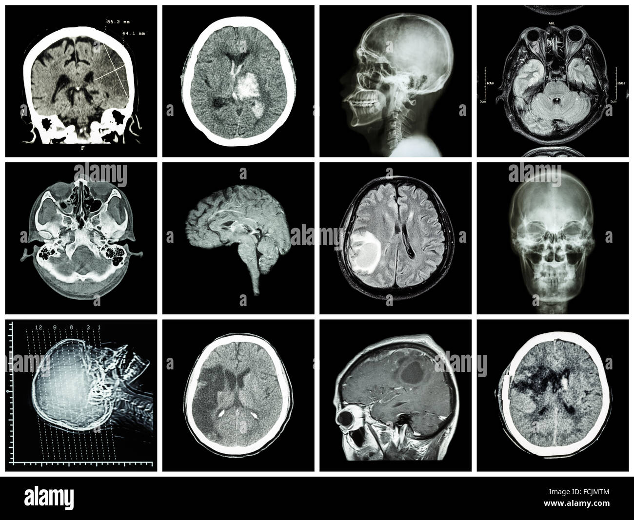 Tomografía Computarizada Del Cerebro