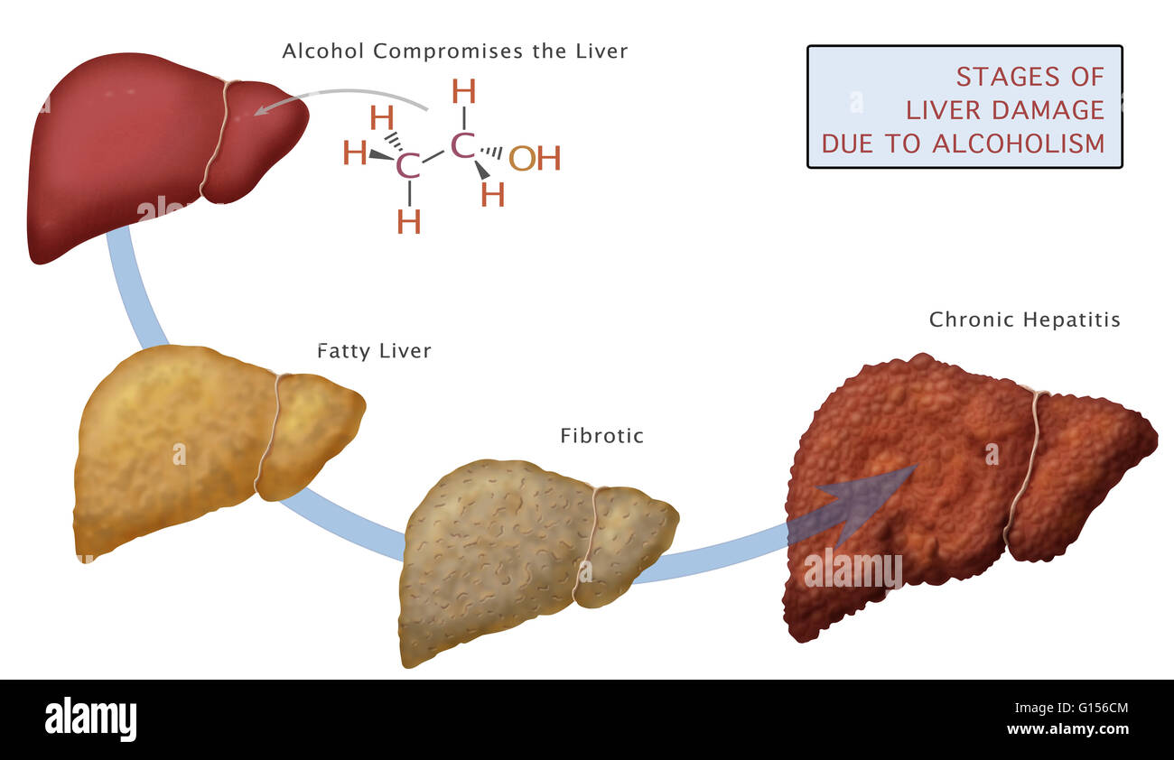 Hígado Afectado Por El Alcohol Antes Y Después