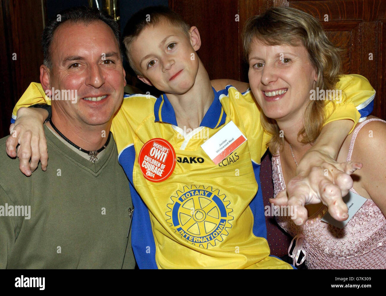 Síndrome De Proteus Antes E Depois - RETOEDU