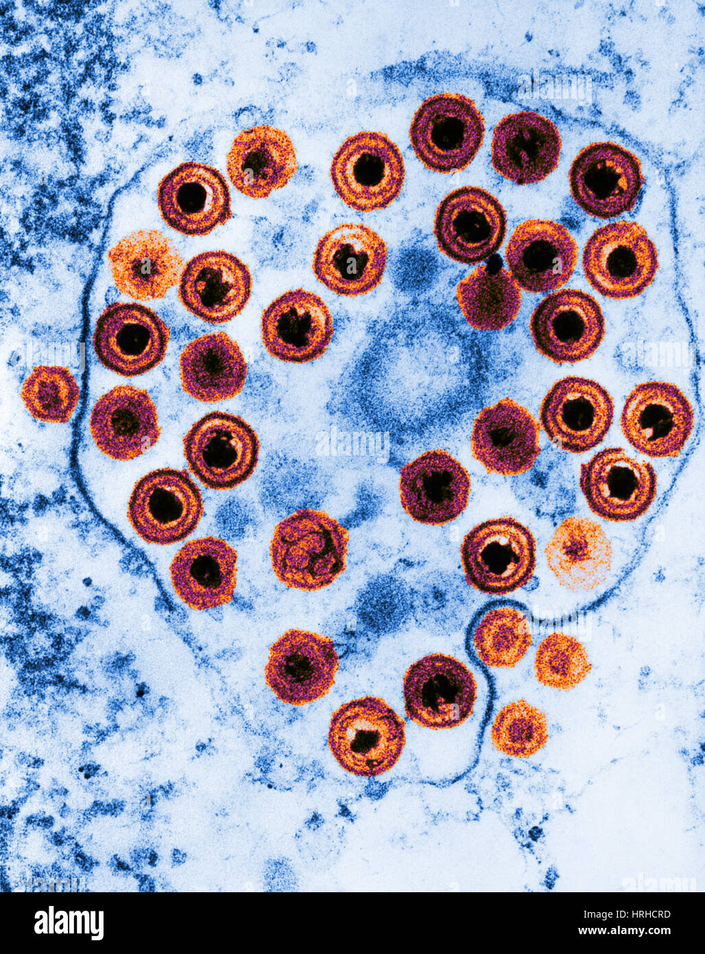 Encefalitis Por Herpes Simple Fotografías E Imágenes De Alta Resolución