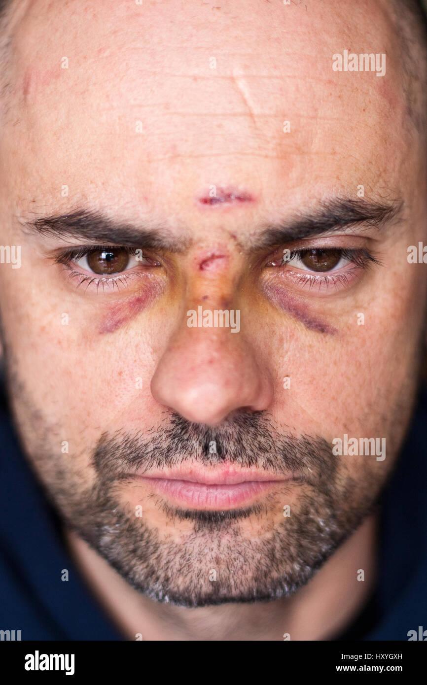 Cara De Un Hombre Herido Con Heridas Y Ojos Negros Soft Focus