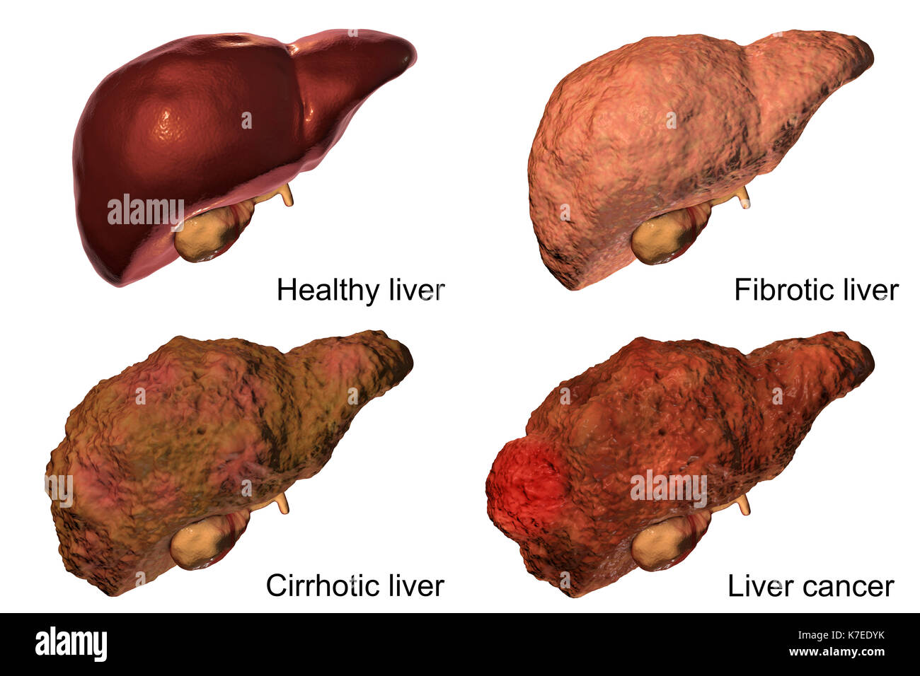 Liver Higado