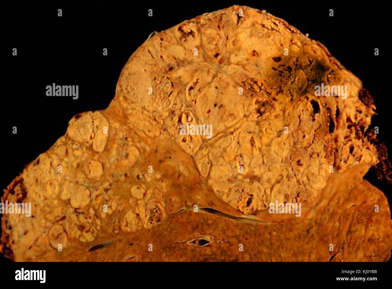 Ressonancia Magnetica De Carcinoma Hepatocelular