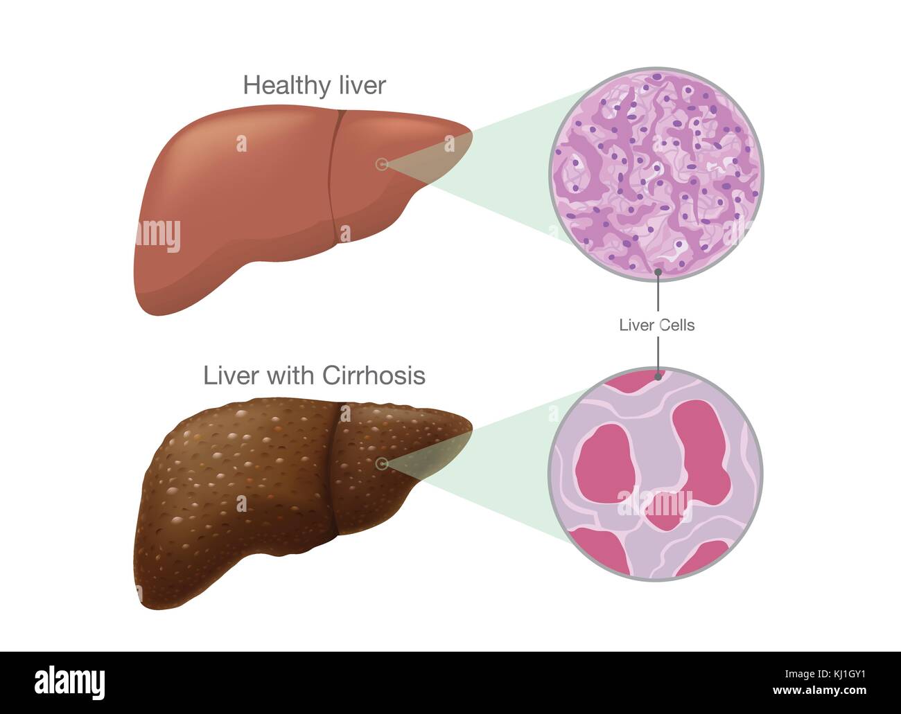 Cirrosis Del Higado Vs Higado Sano