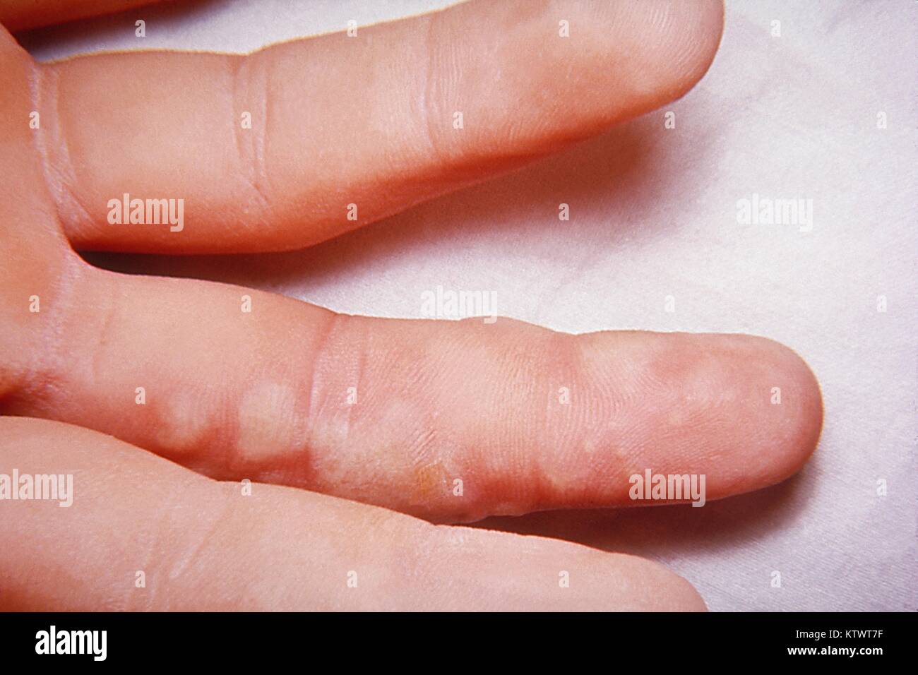 Lesiones De Herpes Simple Fotografías E Imágenes De Alta Resolución Alamy