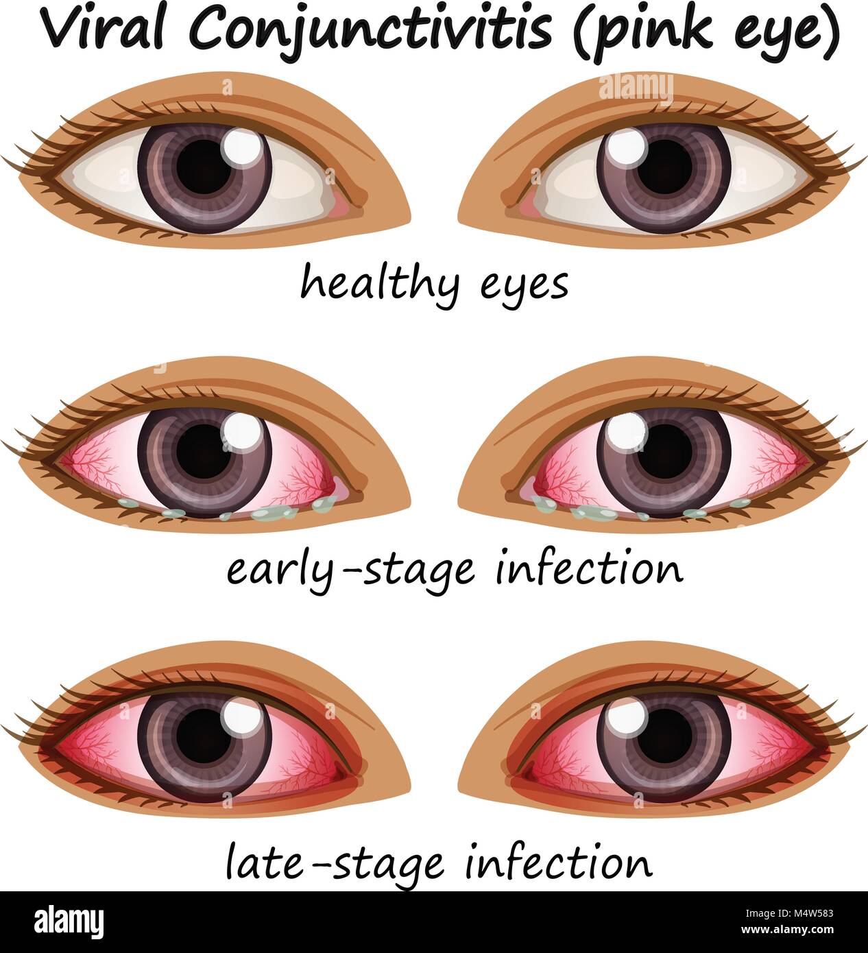 Conjuctivitis Viral En Ojos Humanos Ilustración Imagen Vector De Stock