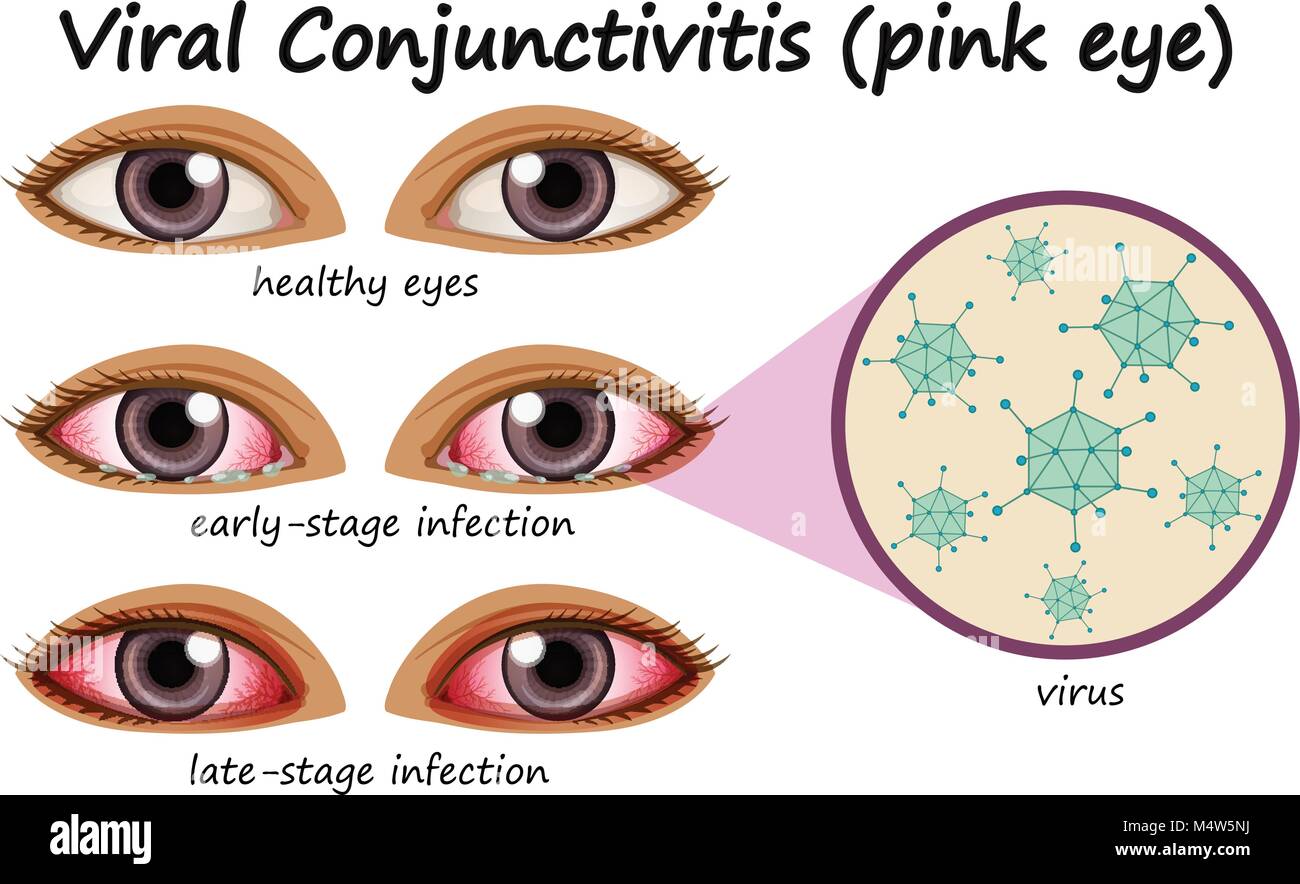 Enfermedad Del Ojo Humano Con La Conjuntivitis Viral Ilustración Imagen