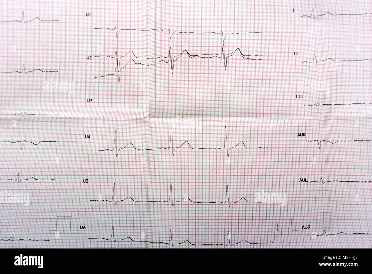 Electrocardiograma Infarto