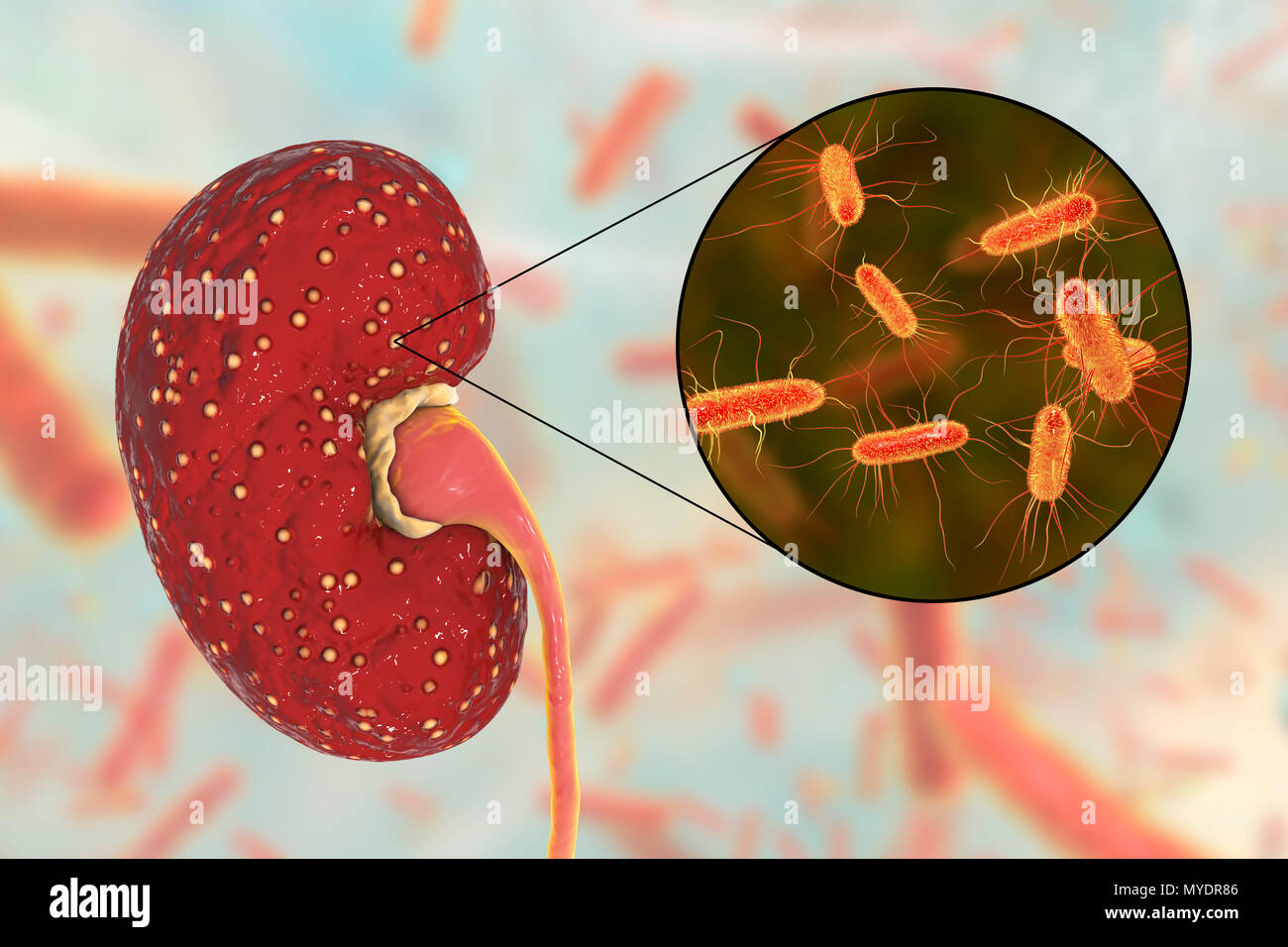 pielonefritis: acute pyelonephritis – TJTO