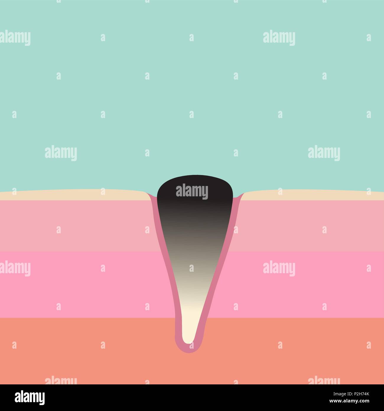 Ilustración Vectorial De Blackhead Diagrama De Estructura De Capas De