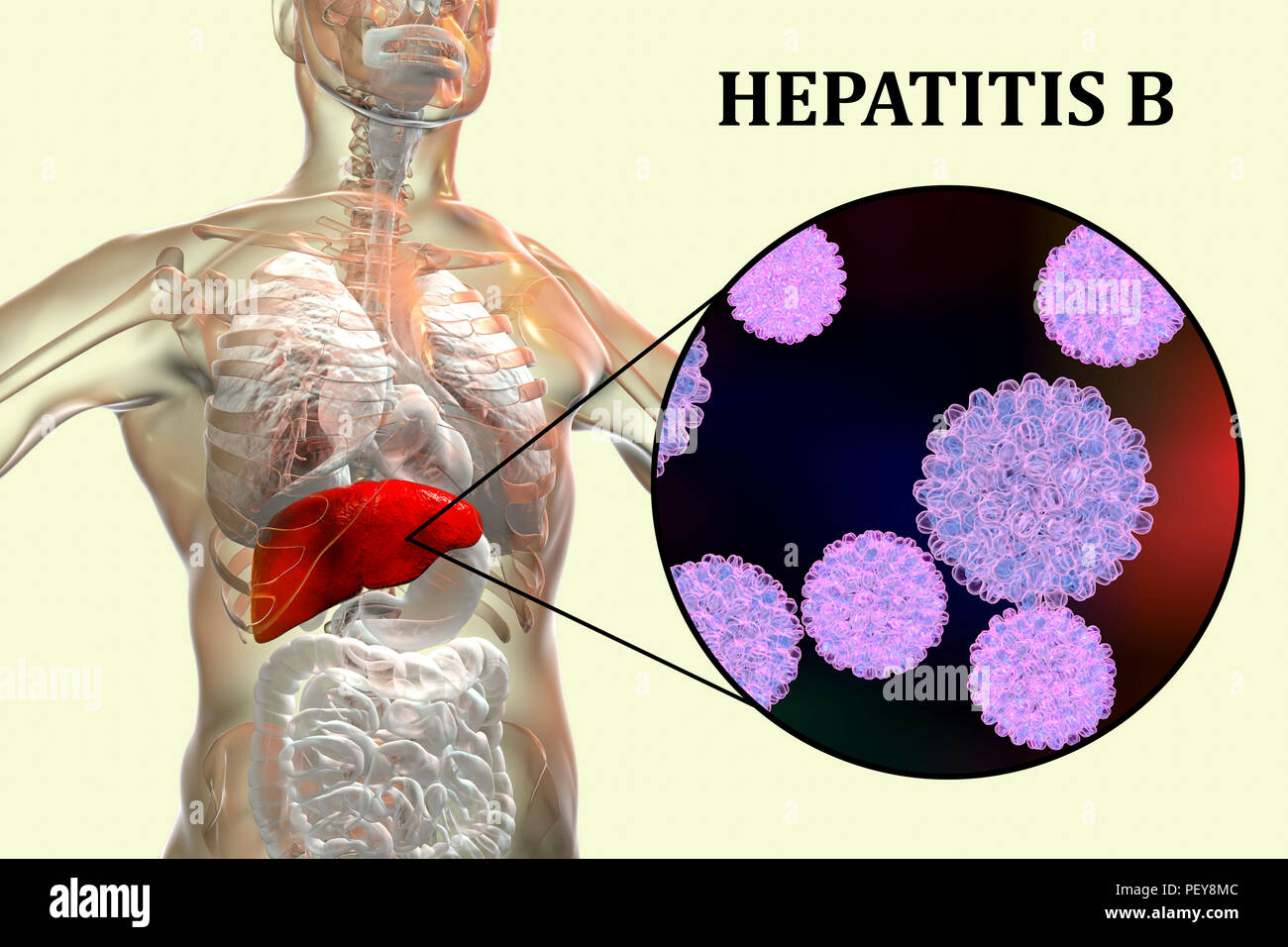 La infección por hepatitis B. Equipo ilustración mostrando el hígado y ...