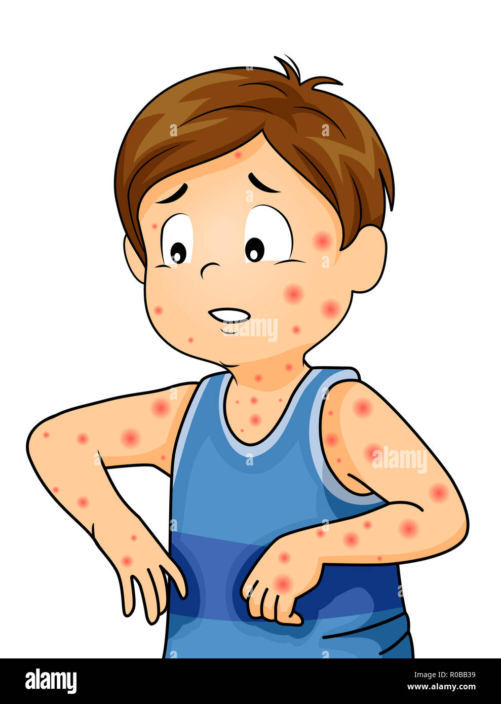 Ilustración De Un Niño Chico Con Erupciones En Todo El Cuerpo De La