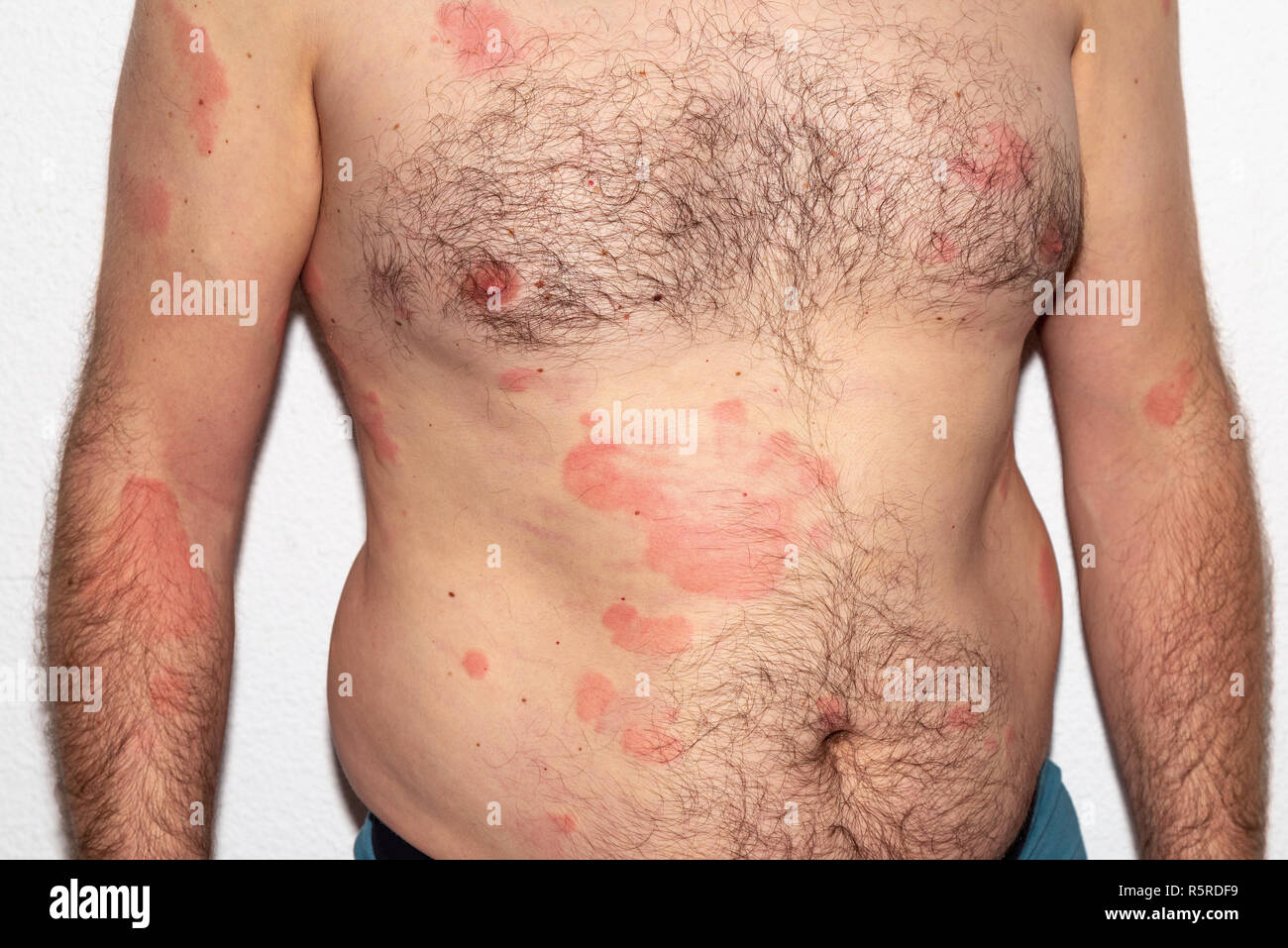 Hombre Con Dermatitis Problema De Erupción Erupción Cutánea De Alergia Reacción De Histamina